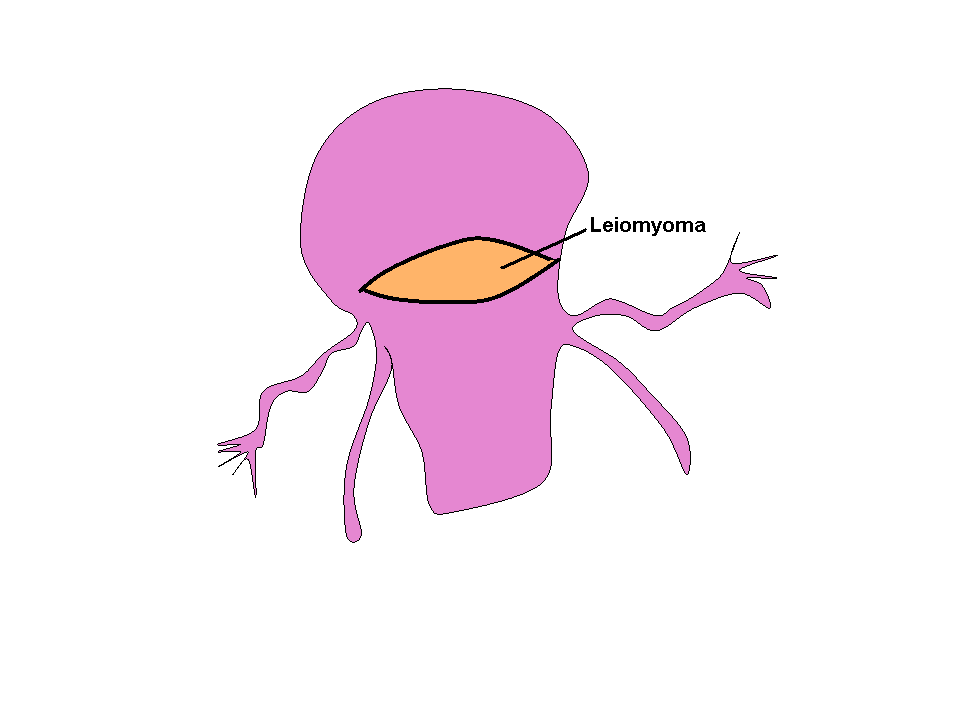 शशांक परुळेकर: Bonney's Hood Operation: Inverted T-shaped Incision