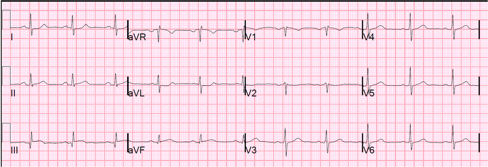 Dr. Smith's ECG Blog: Dynamic inferior MI: STEMI or Non-STEMI? Does it ...