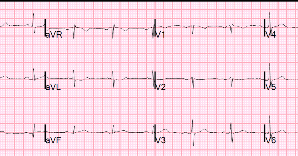 Dr. Smith's ECG Blog: Dynamic inferior MI: STEMI or Non-STEMI? Does it ...