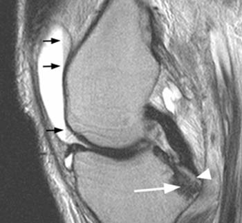 Radiology Channel: Anatomy of bundles of ACL and PCL.