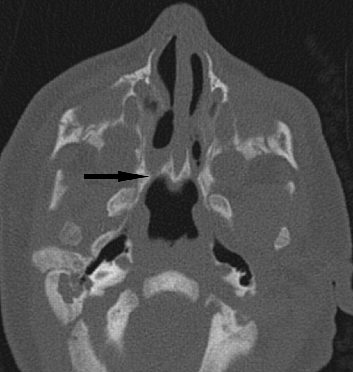ENT for medical students: NOSE - Congenital
