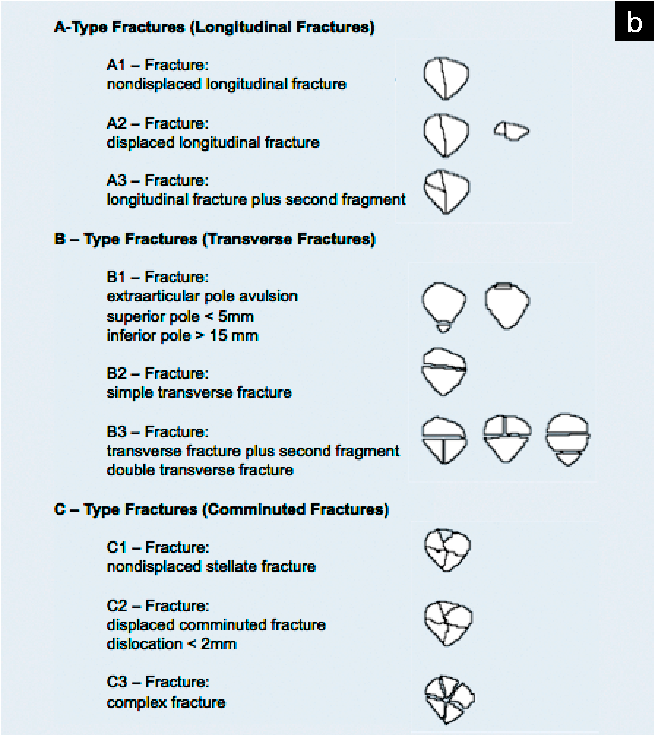 Patella Fracture Case Presentation