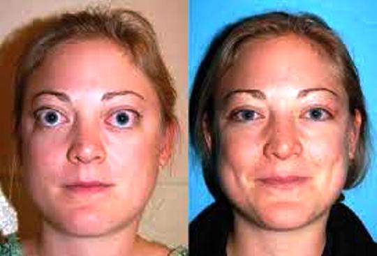 Obat Herbal Penyakit Tiroid Pada Mata ~ Khasiat Teripang Emas