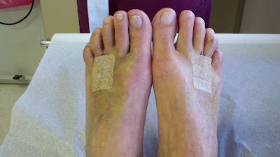 All About Morton's Neuroma: Surgery & Recovery