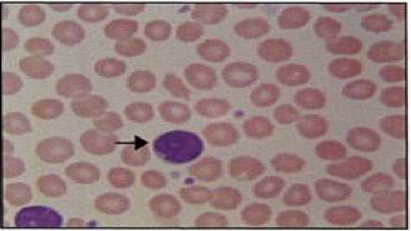 fichero hematologia: Prolinfocito