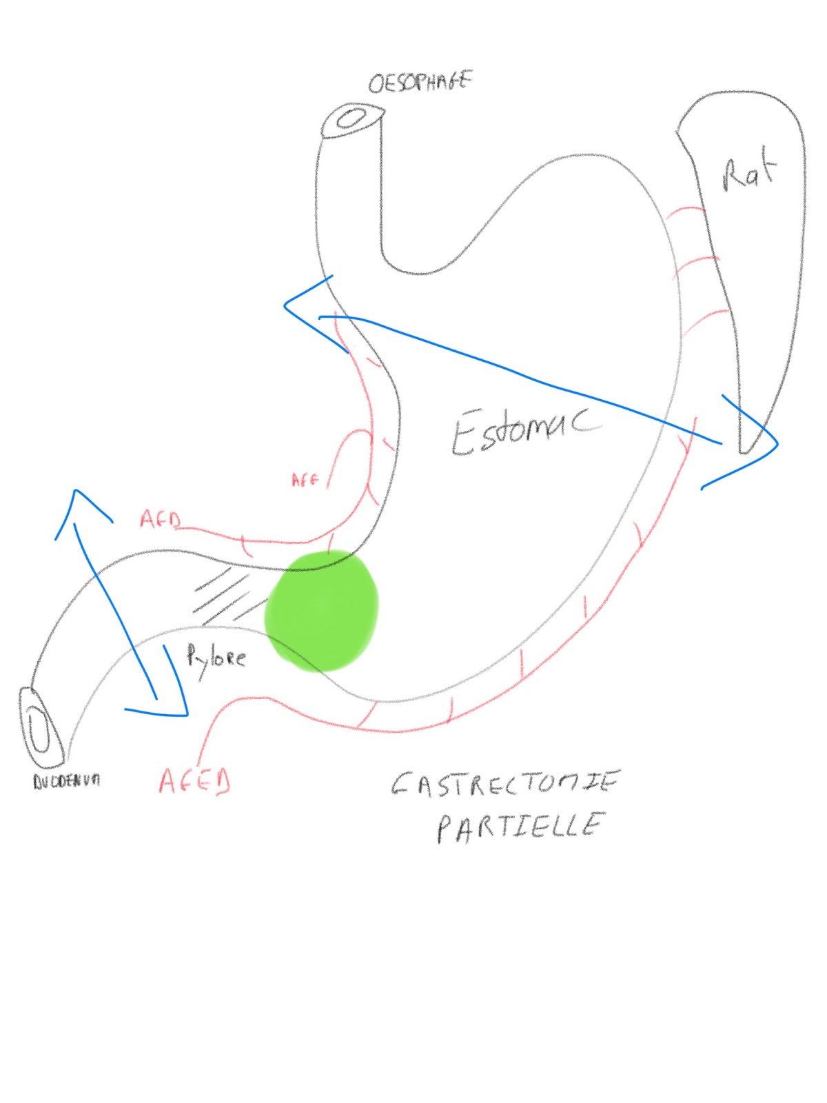 CHIRURGIE DIGESTIVE ET HEPATO-BILIAIRE: Gastrectomies (schémas explicatifs)