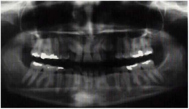 Dentistry and Medicine: Surgical management of Unerupted and Impacted teeth