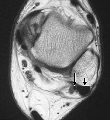 MRI Musculo-Skeletal Section: Peroneal tendon lesions.