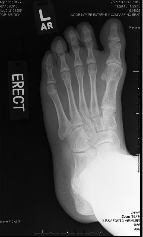 Sesamoid Bone X Ray