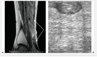 Orthopaedi dan Traumatologi: CIDERA TENDON ACHILLES PADA OLAH RAGA