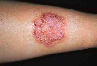 Factsramblog: Ringworm (Tinea) FACTS