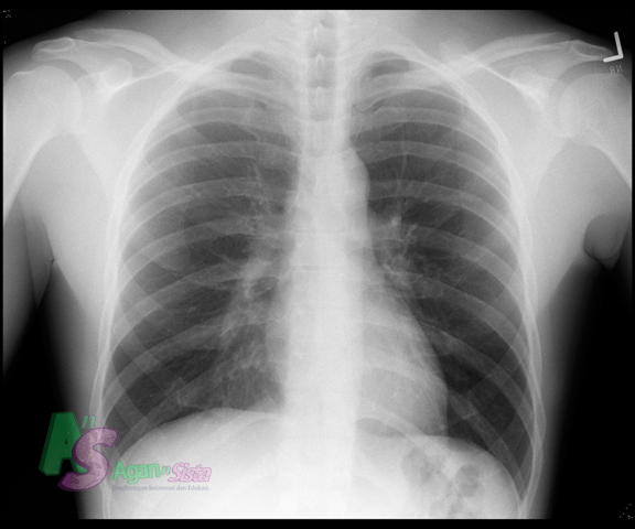 Tips Cara Membersihkan Paru-Paru | KEMENAG PONTIANAK