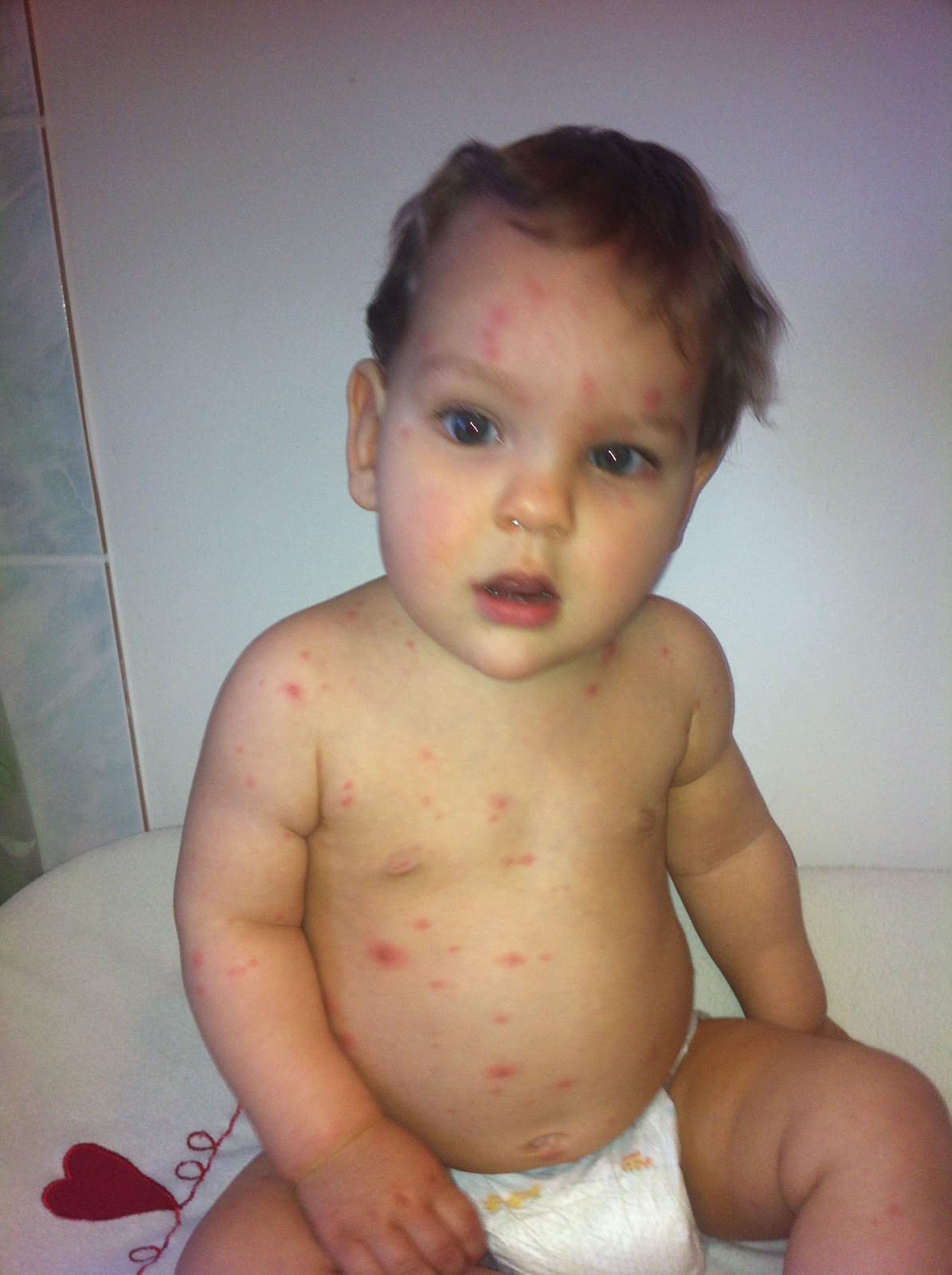 Un petit bout de nous...: La varicelle