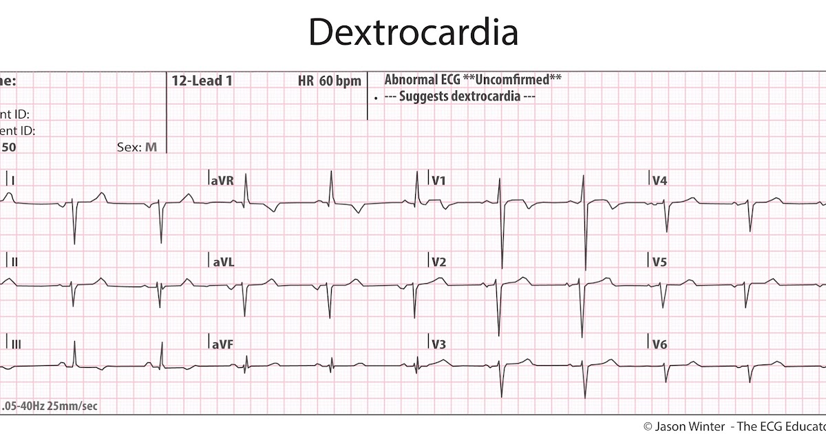 ECG Educator Blog : Dextrocardia