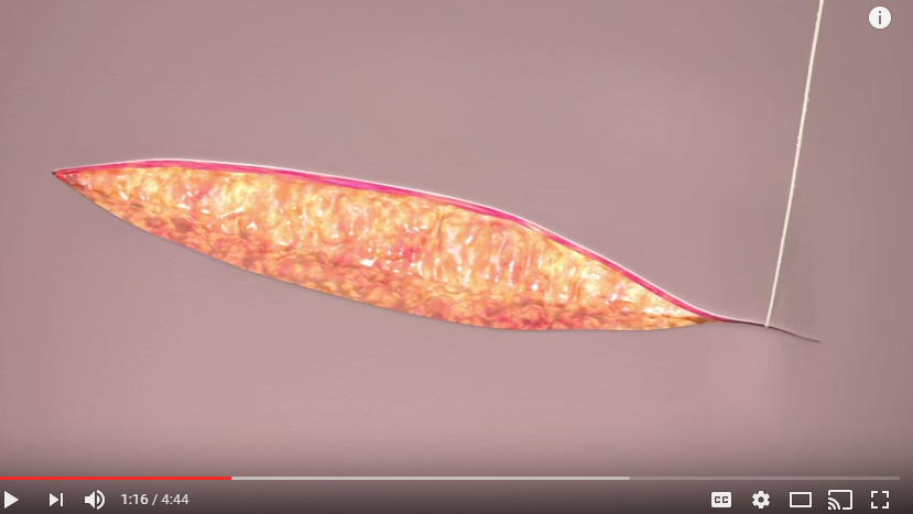 Ob/Gyn Updated : Ethicon STRATAFIX™ Spiral Plus Devices transforms ...