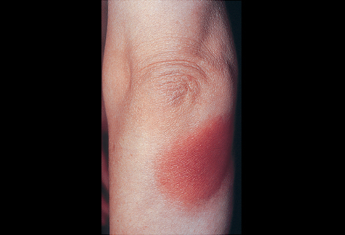 Dentistry and Medicine: Adverse Drug Reactions in the Oro facial Region