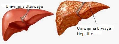Uko wakwirinda indwara y'umwijima ikunze gutera kanseri n'urushwima ...