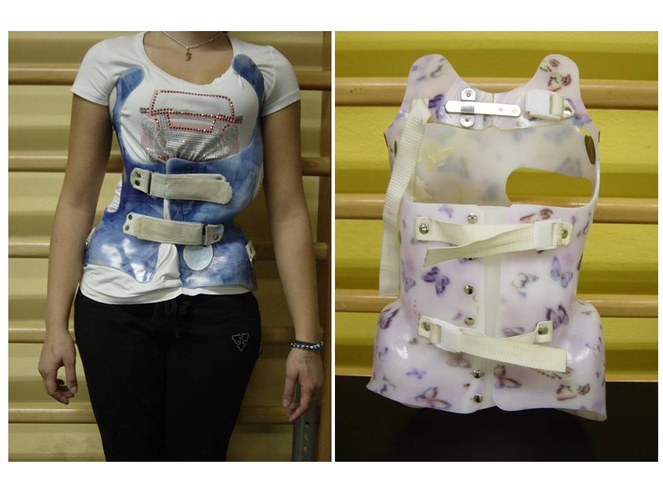 Despre corsetul Cheneau :: Corset scolioza / scoliosis braces