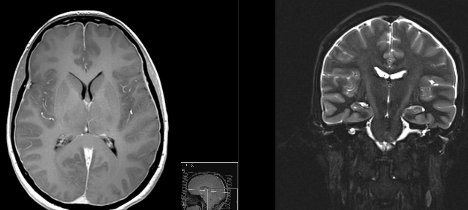 CSF Leakage - Intracranial Hypotension CSF Leakage - Intracranial Hypotension