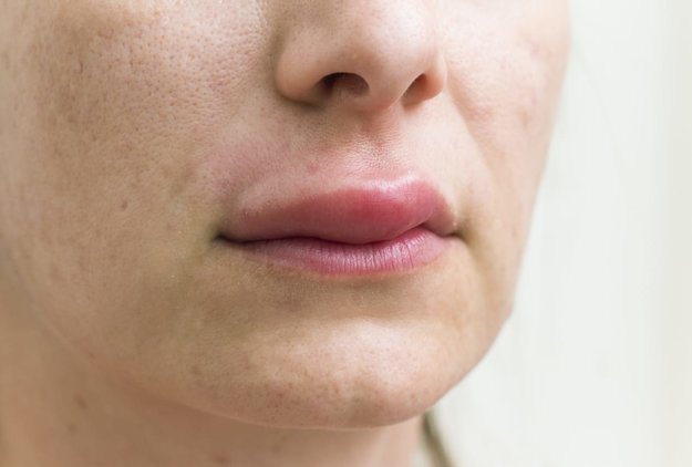 What Is Angioedema