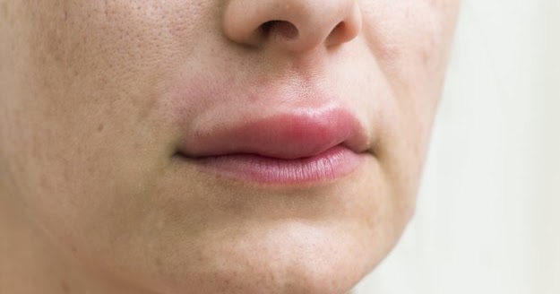 What Is Angioedema