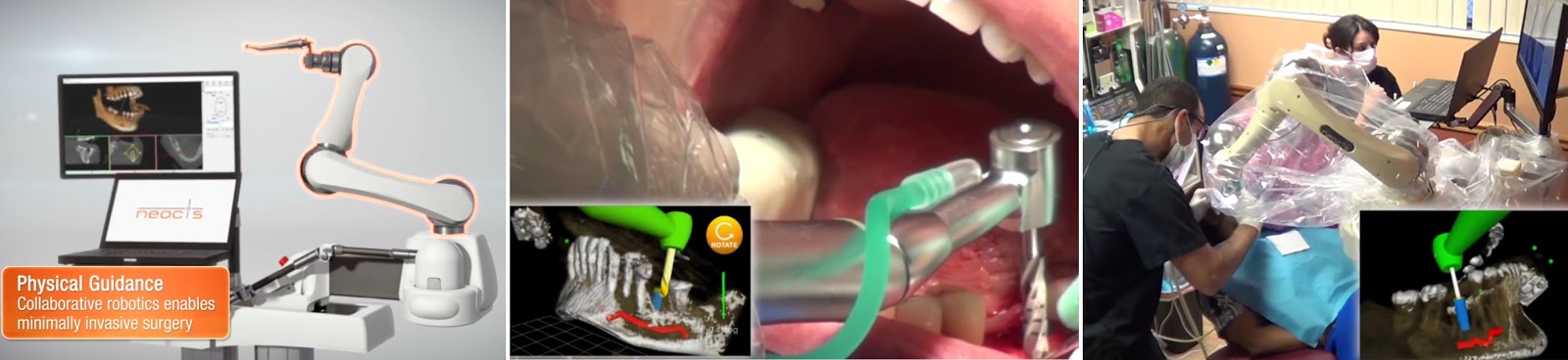Yomi, the first robot for dental implant procedures