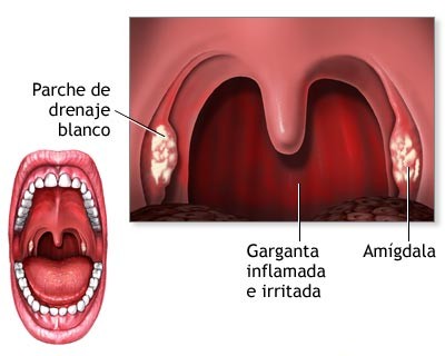 Futura médica... y algo más: FARINGITIS