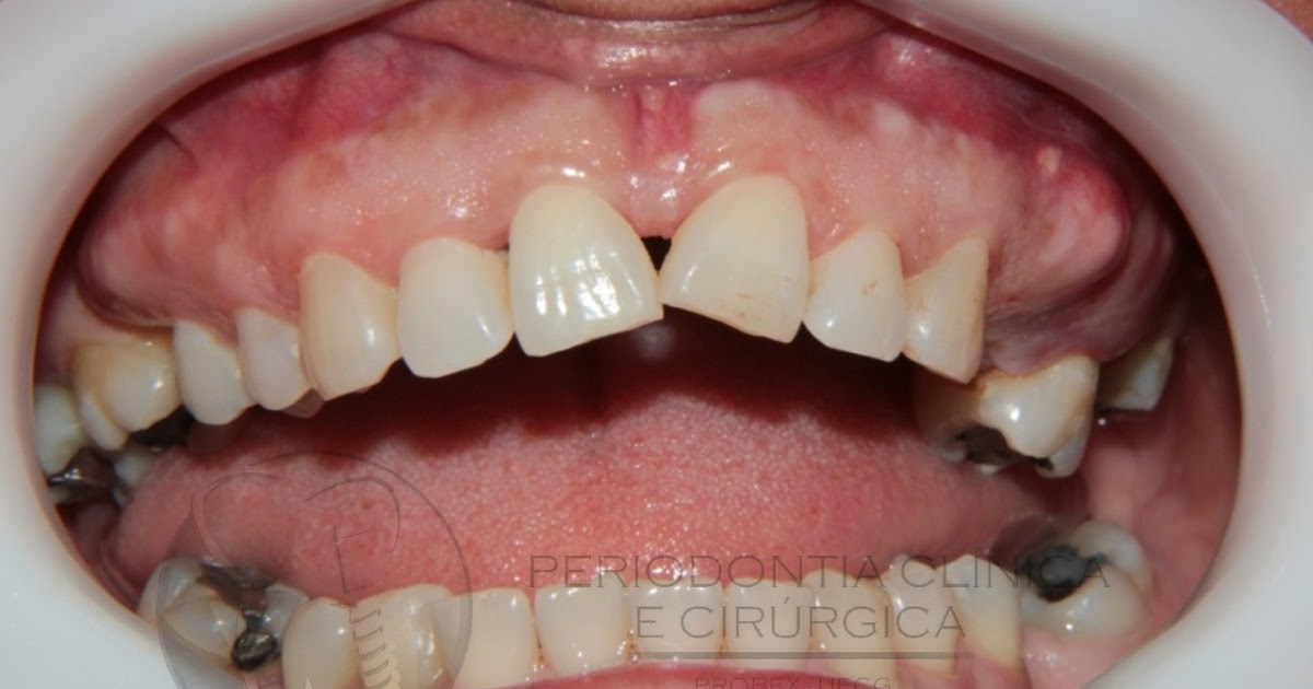 REMOÇÃO DE EXOSTOSE MAXILAR: RELATO DE CASO