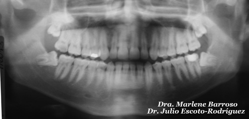 Casos de Cirugía Bucal y Maxilofacial : Caso No. 47: Exodoncia de ...