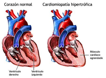 Ecuarritmias: Hipertrofia ventricular izquierda, ¿qué es y qué la causa?