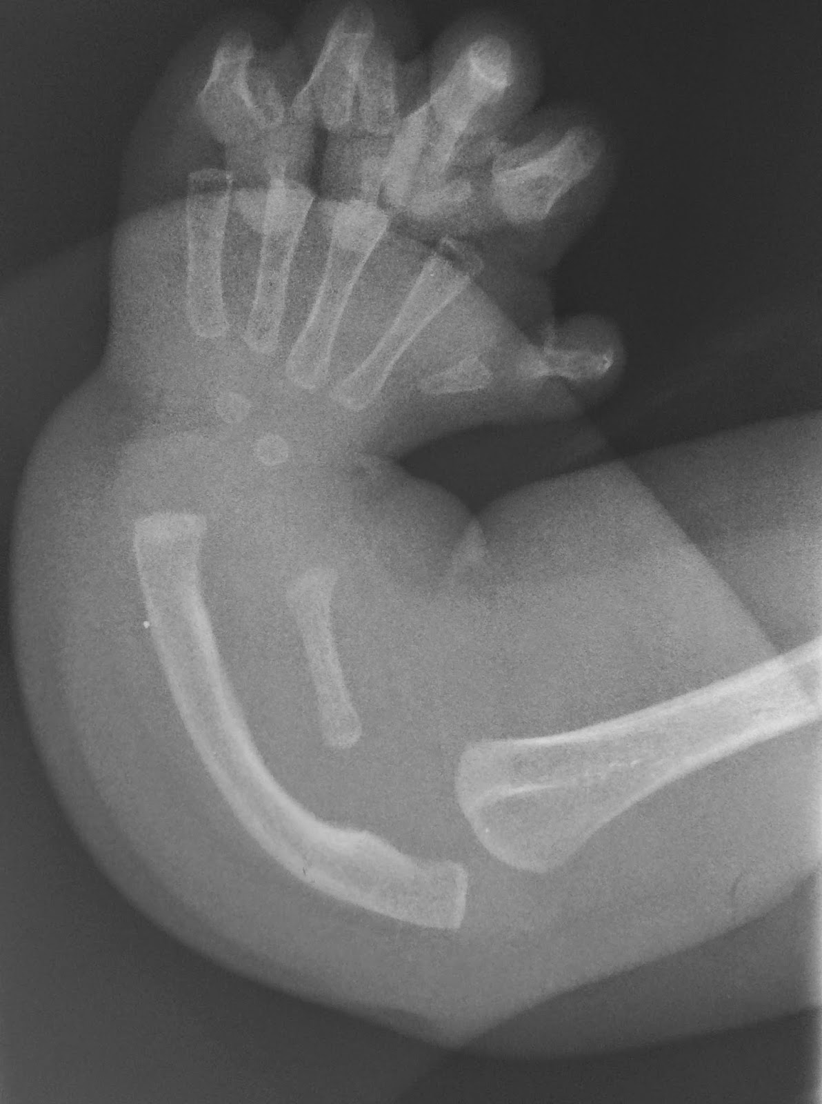 Type 2 Radial Longitudinal Deficiency | Congenital Hand and Arm ...