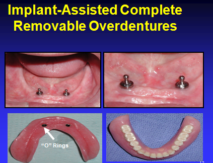 dentalaka: Dental Implants: A Treatment for the Geriatric (Elderly) Person