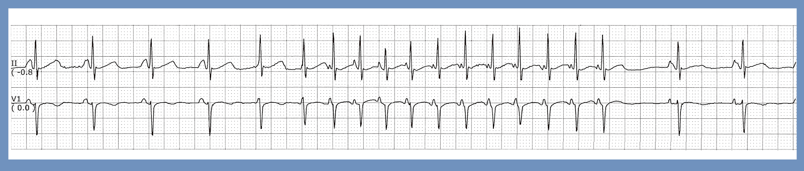 Practice EKG Strips 332