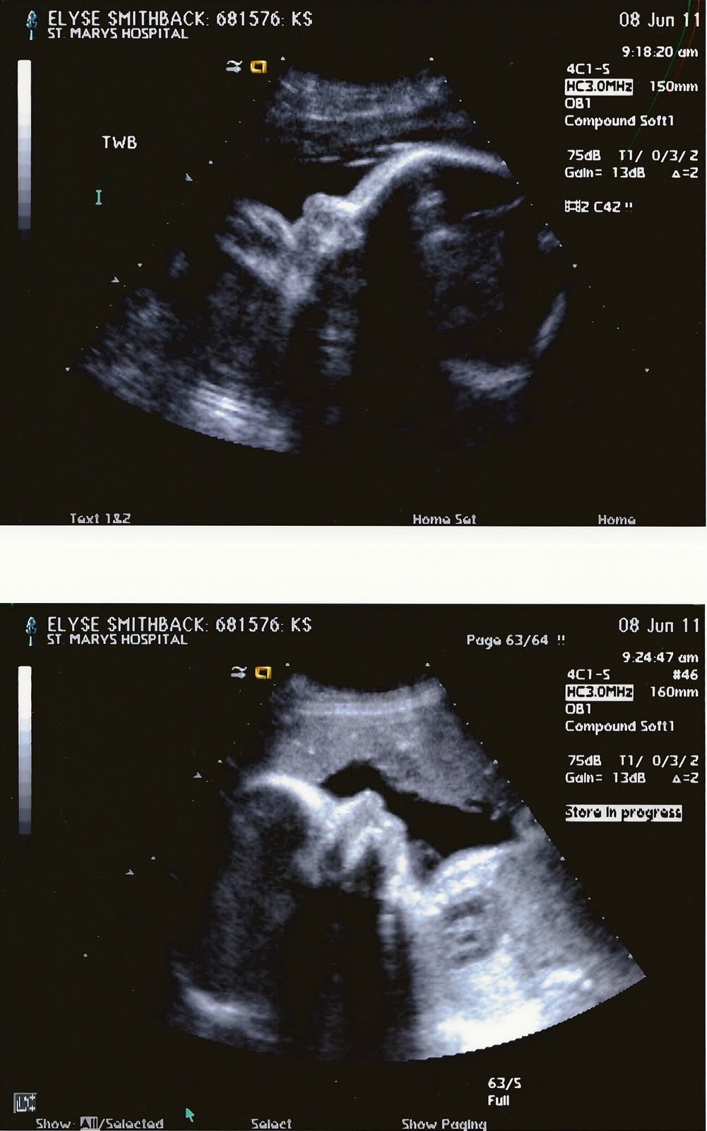 Smithback Twins: 34 Week Scan & Picture!