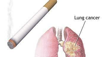 #52 Cigarette smoking and health | Biology Notes for A level