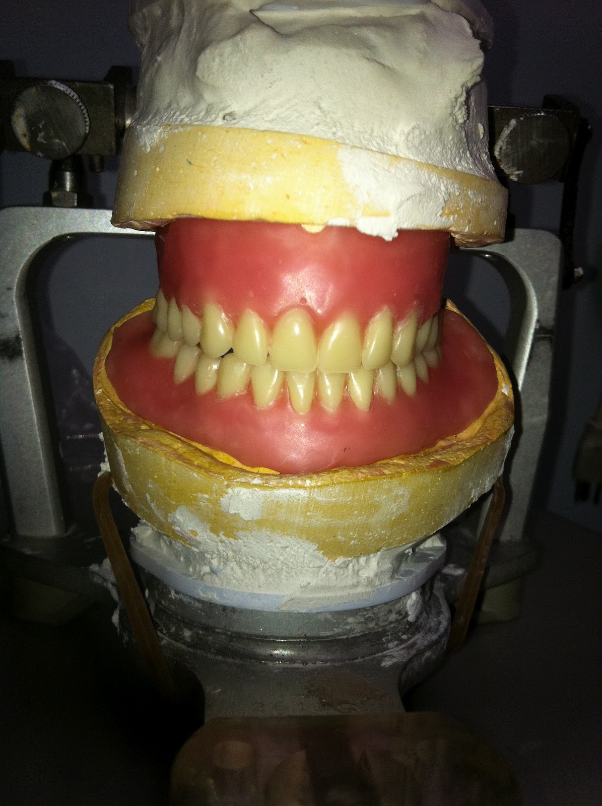 Casos clínicos: Prótesis total