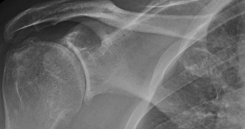 Shoulder Arthritis / Rotator Cuff Tears / Shoulder Pain : Preoperative ...