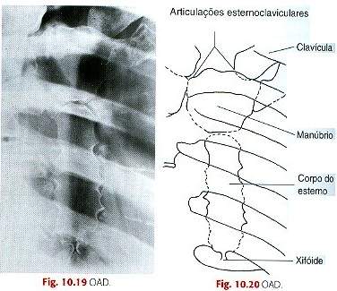 DICAS DE RADIOLOGIA - Tudo Sobre Radiologia: RAIO-X OSSO ESTERNO ...