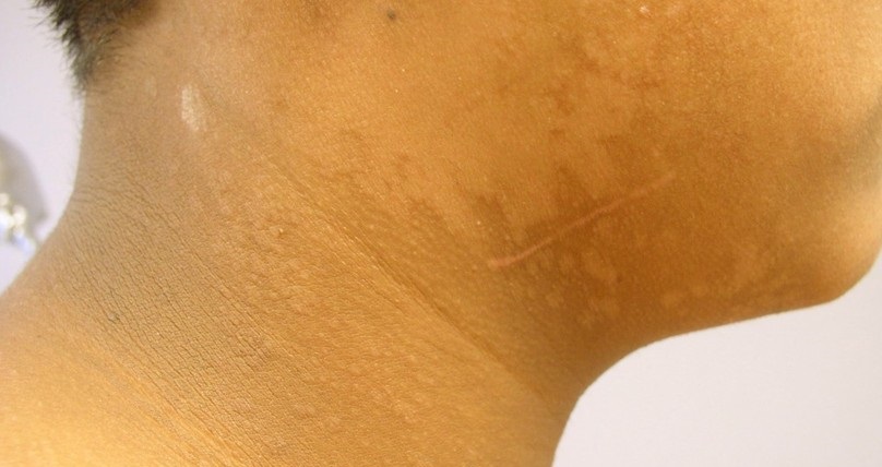 Why Happen White Spots on Skin Causes and Possible Treatments ...