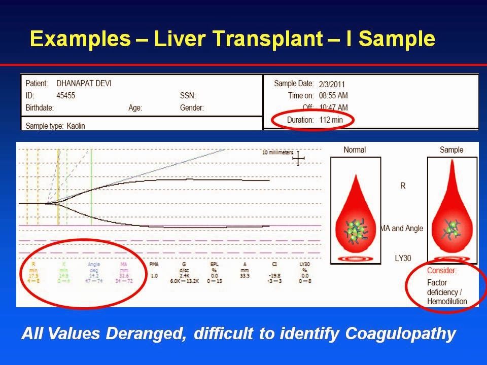 Comparison of Sonoclot with Thromboelastography TEG in Liver Transplant