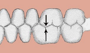 Daily Dentist: What's that Word? Dental Jargon from A to Z: O is for ...
