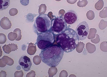Kanker Darah / Leukemia
