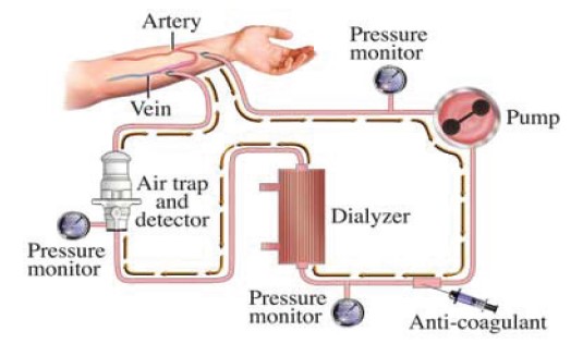 Materi Pengayaan: Cuci Darah (Hemodialisis) dan Transpalansi Ginjal ...