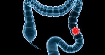 Pengobatan Tradisional Obstruksi Usus | Kumpulan Tips Kesehatan Terupdate