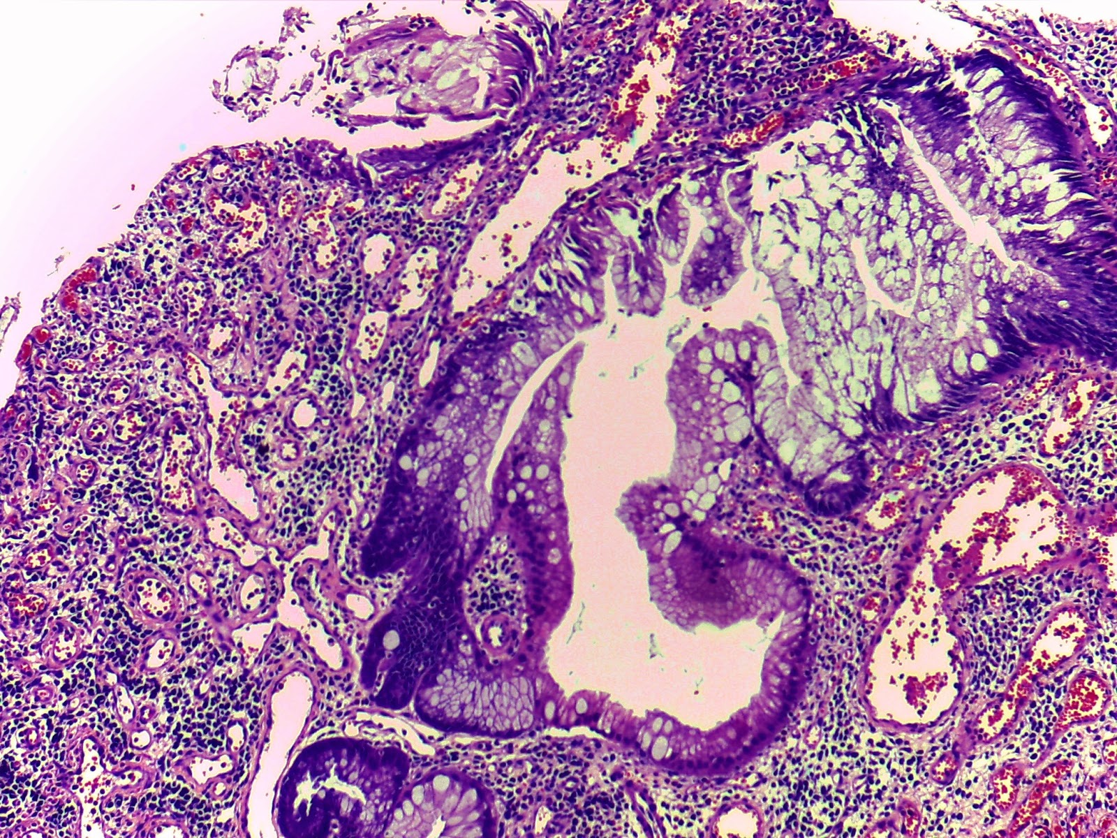 GASTROINTESTINAL AND LIVER HISTOLOGY PATHOLOGY ATLAS: COLON: JUVENILE POLYP