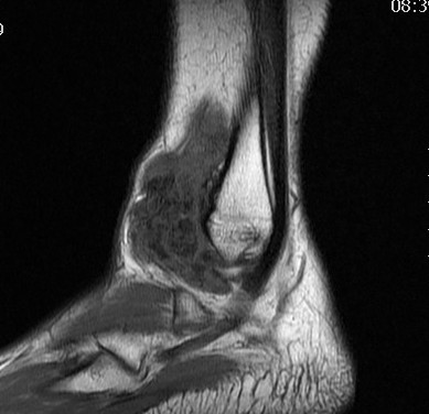 Pigmented Villonodular Synovitis Ankle - Sumer's Radiology Blog