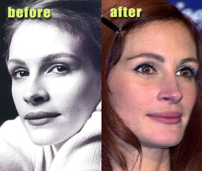 Julia Roberts Plastic Surgery Before and After Nose Job and Facial ...