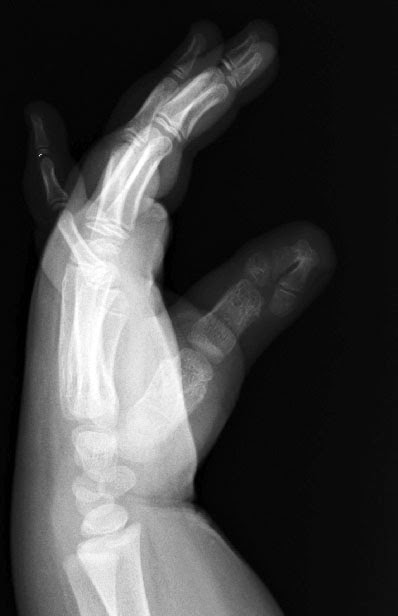 The Big Thumb | Congenital Hand and Arm Differences | Washington ...