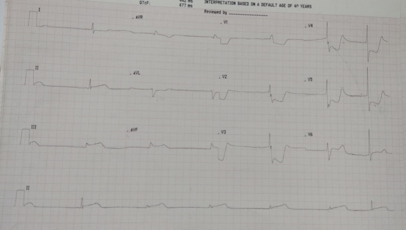 Cardiology window: Posterior wall myocardial infarction with inferior ...