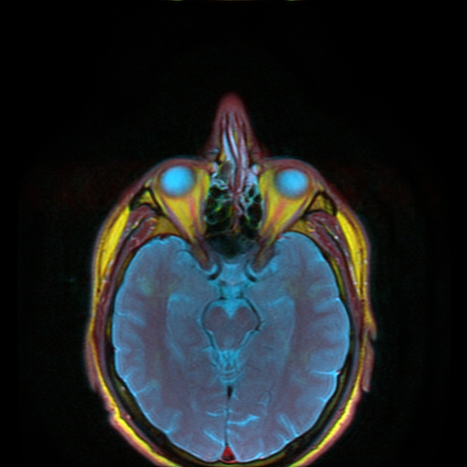 Nevit's blog: Color MRI of the Neck